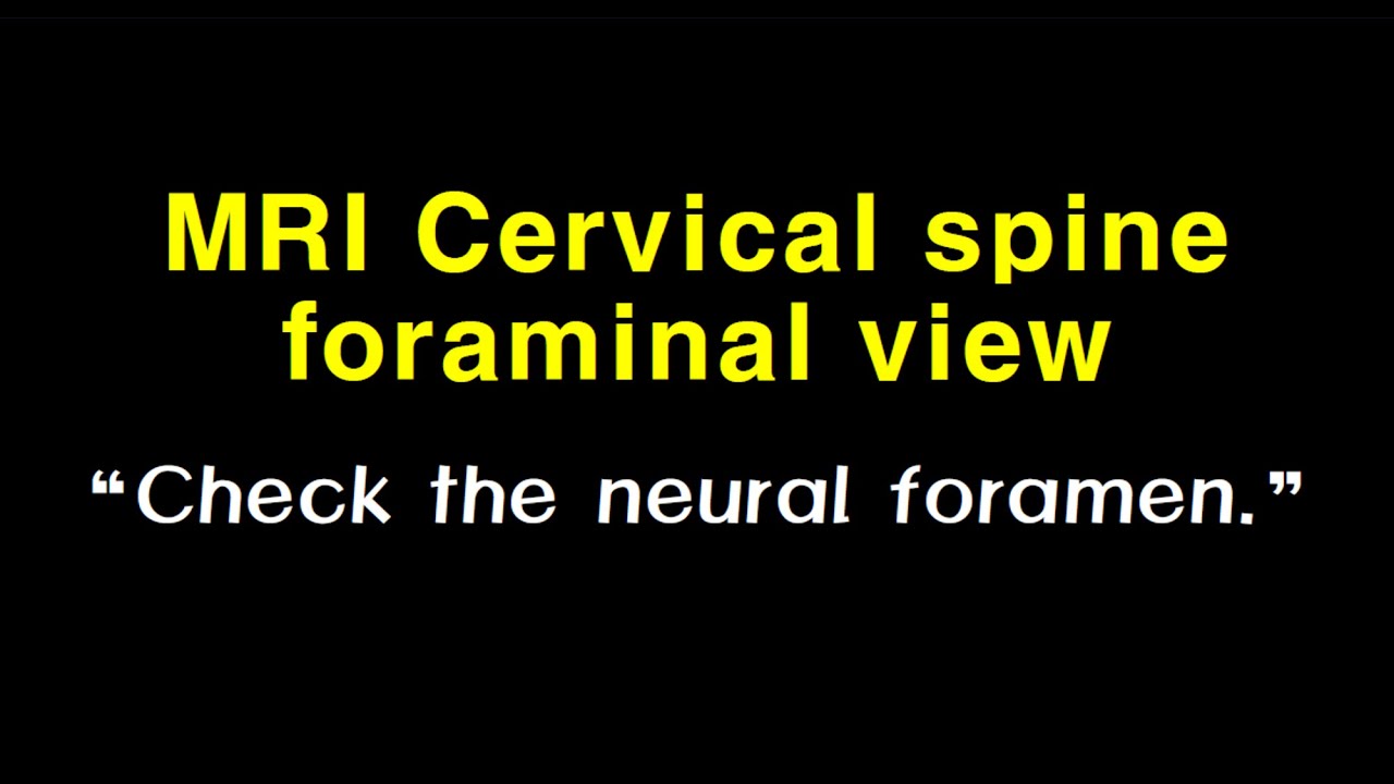 MRI Cervical spine foraminal view_english - YouTube