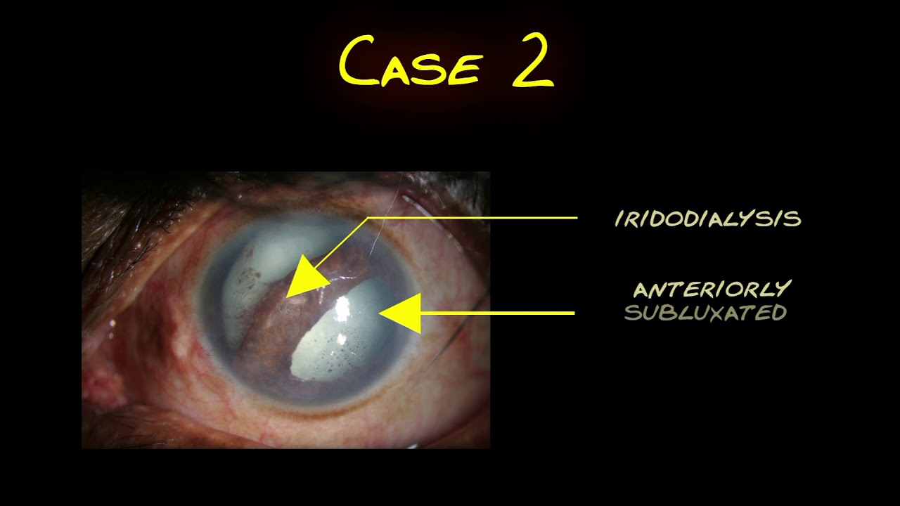 AIOC 2017 - Jaipur - VT162 - Management of Different Types of Traumatic ...