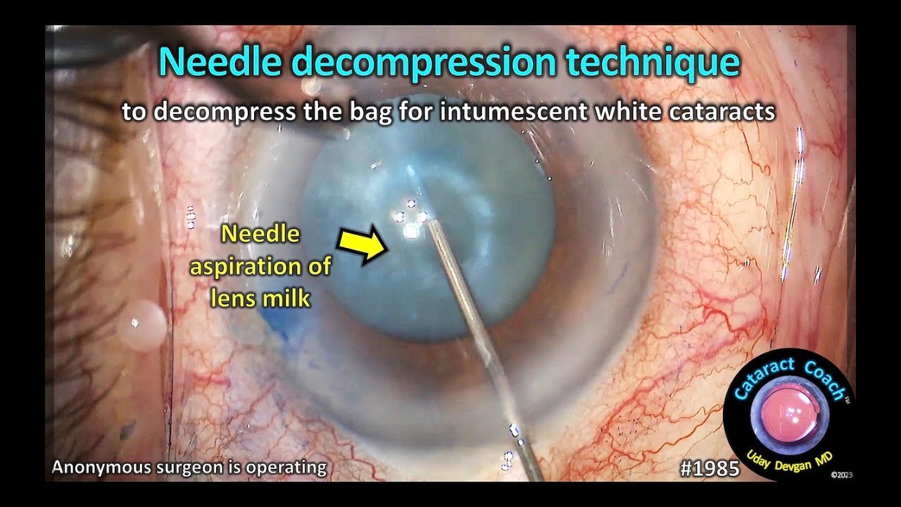 CataractCoach™ 1985: needle decompression for intumescent white cataracts - YouTube