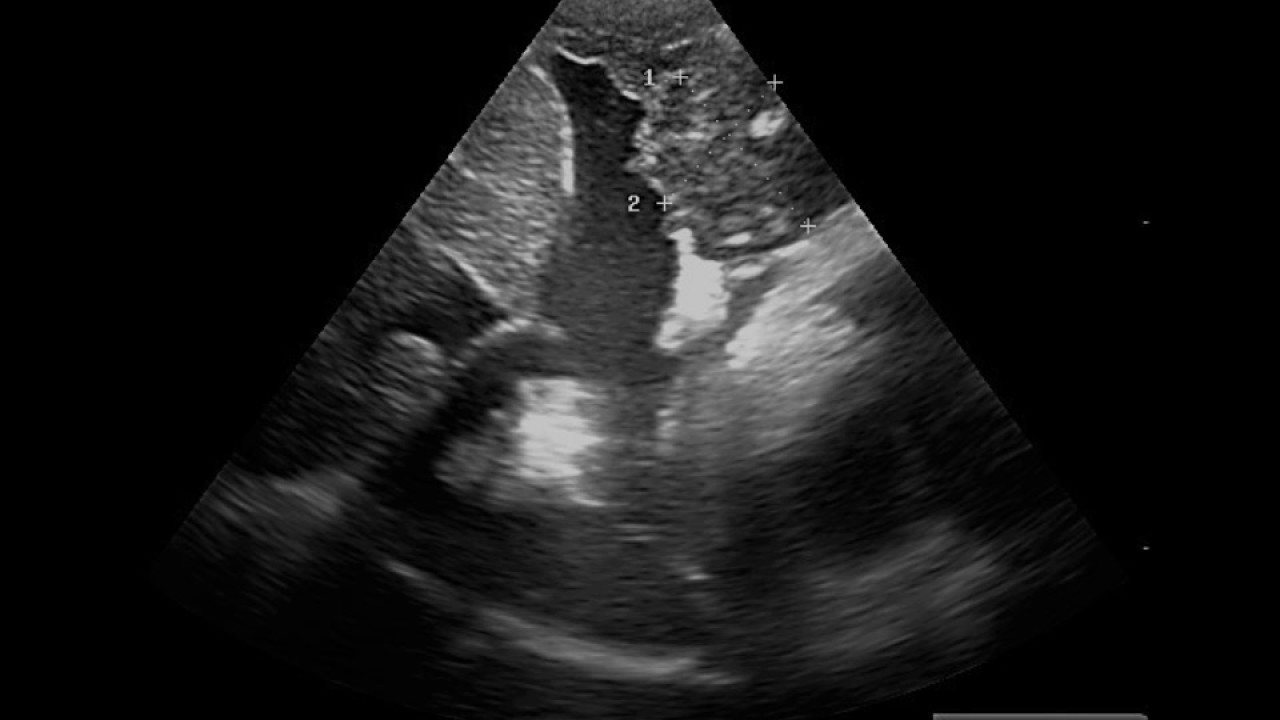Colecta pleural por sarcoma multicéntrico en boxer - YouTube