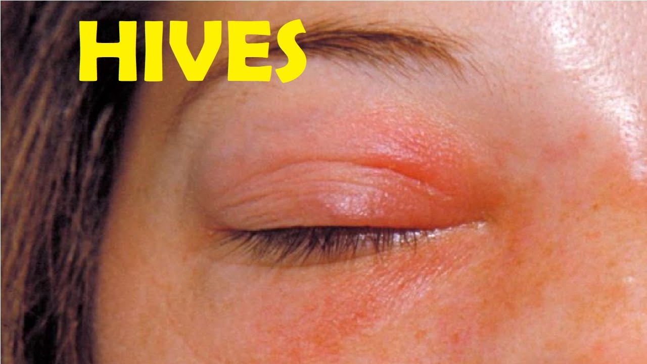 how to get rid of hives on your eyelids - YouTube