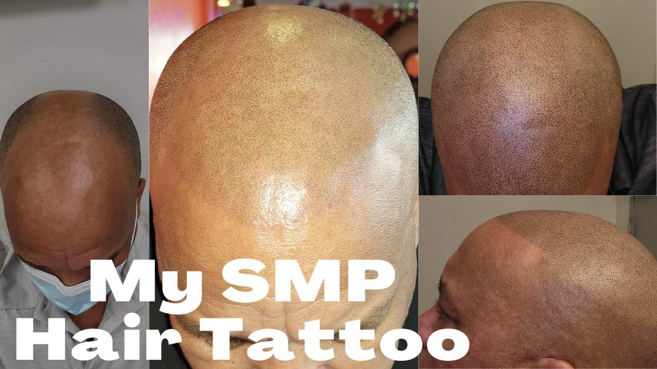 Scalp Micropigmentation Tattoo Transformation Bald To Hairline - YouTube