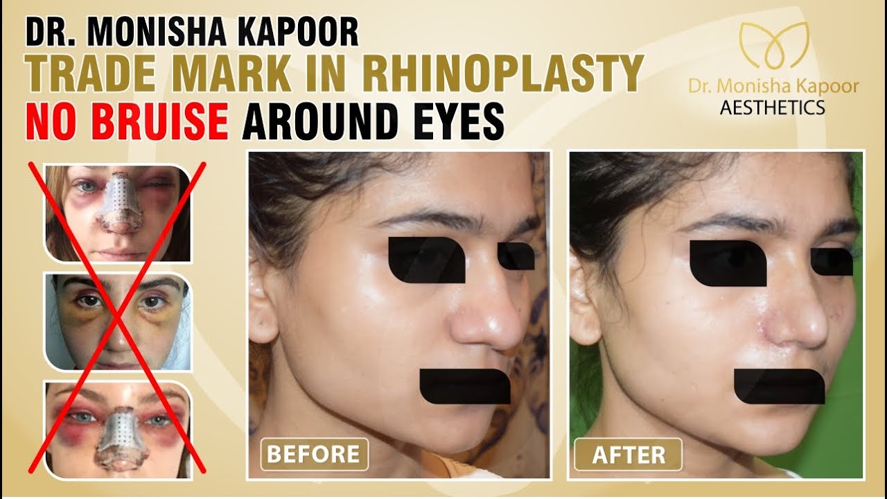 Rhinoplasty Surgery Result After 7 Days - YouTube