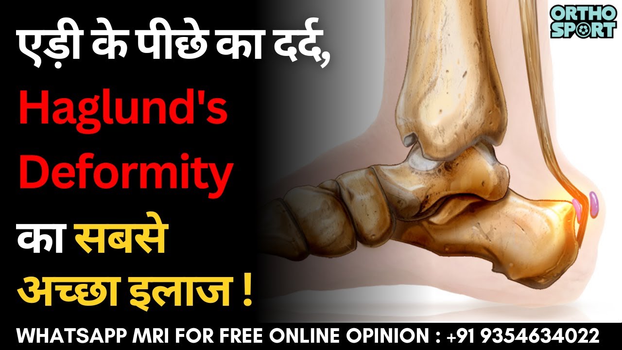 एड़ी के पीछे का दर्द, Haglund's Deformity का सबसे अच्छा इलाज ...