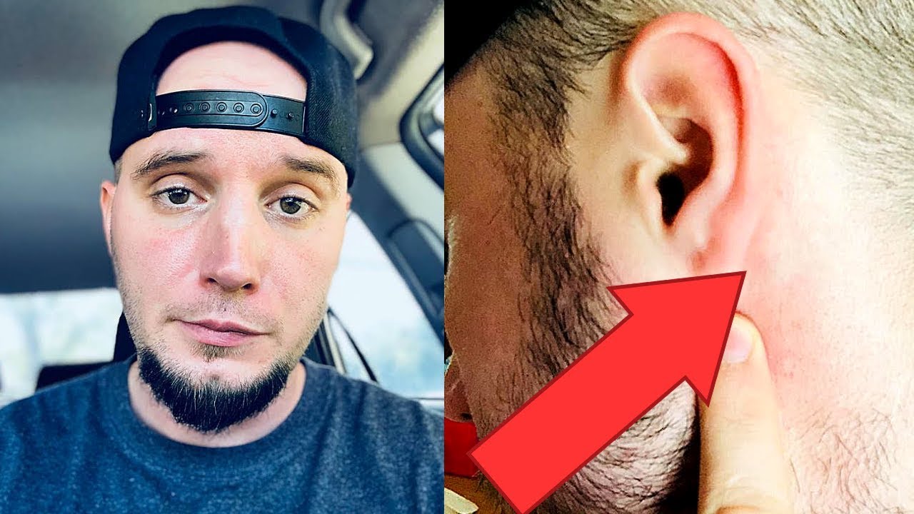 DISAPPOINTING UPDATE On The Lump Behind My Ear YouTube disappointing-update-on-the-lump-behind-my-ear-youtube