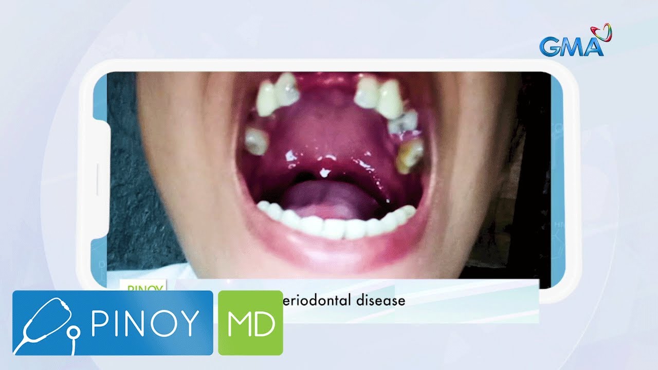 Pananakit ng ngipin, senyales ba ng iba pang karamdaman? | Pinoy MD ...