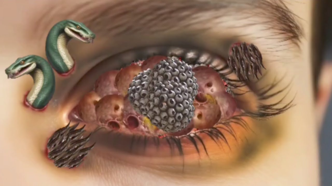 ASMR Animation treatment Infected Eye || Eyes Treatment 2D Animation ...