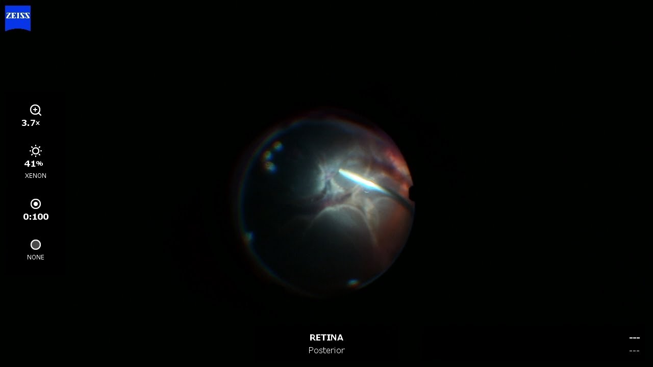Open Funnel Retinal Detachment Repair - YouTube