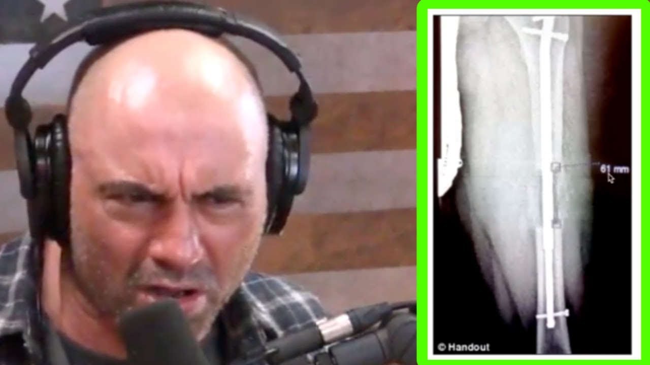 Joe Rogan FREAKS OUT Over Brutal Leg-Lengthening Surgery! - YouTube