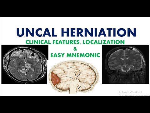 Uncal Herniation Cranial Nerve 3