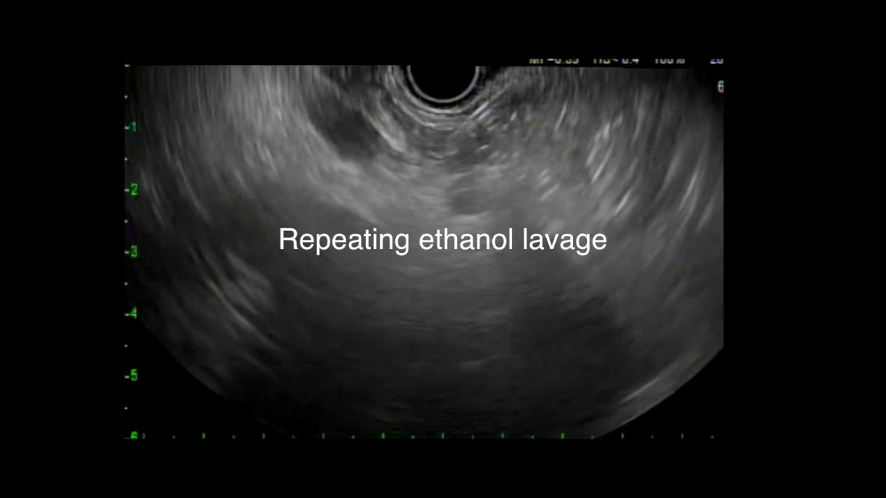 Eus Guided Cyst Ablation By Dr Radhika Chavan Youtube