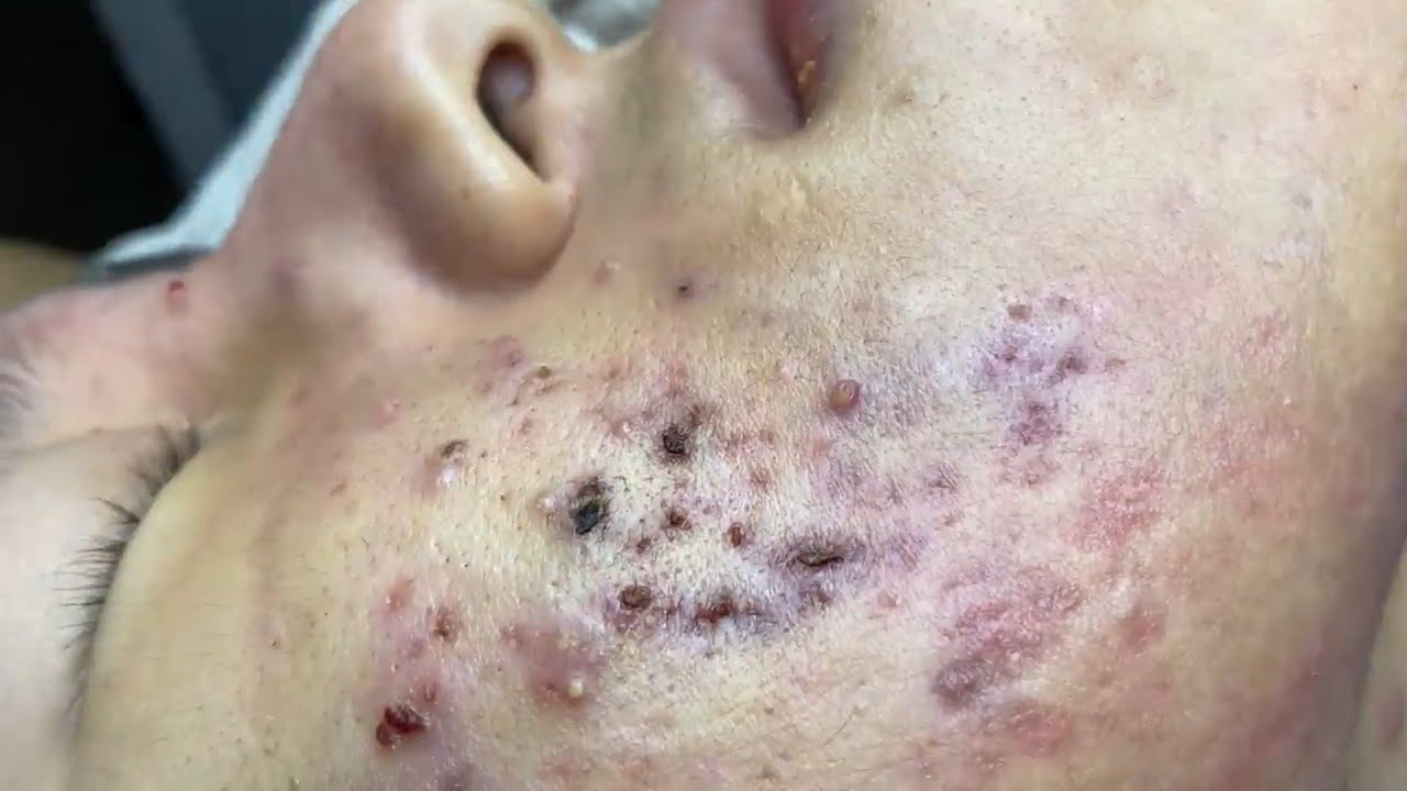 Relaxing blackheads removal and pimple popping | blackheads removal ...