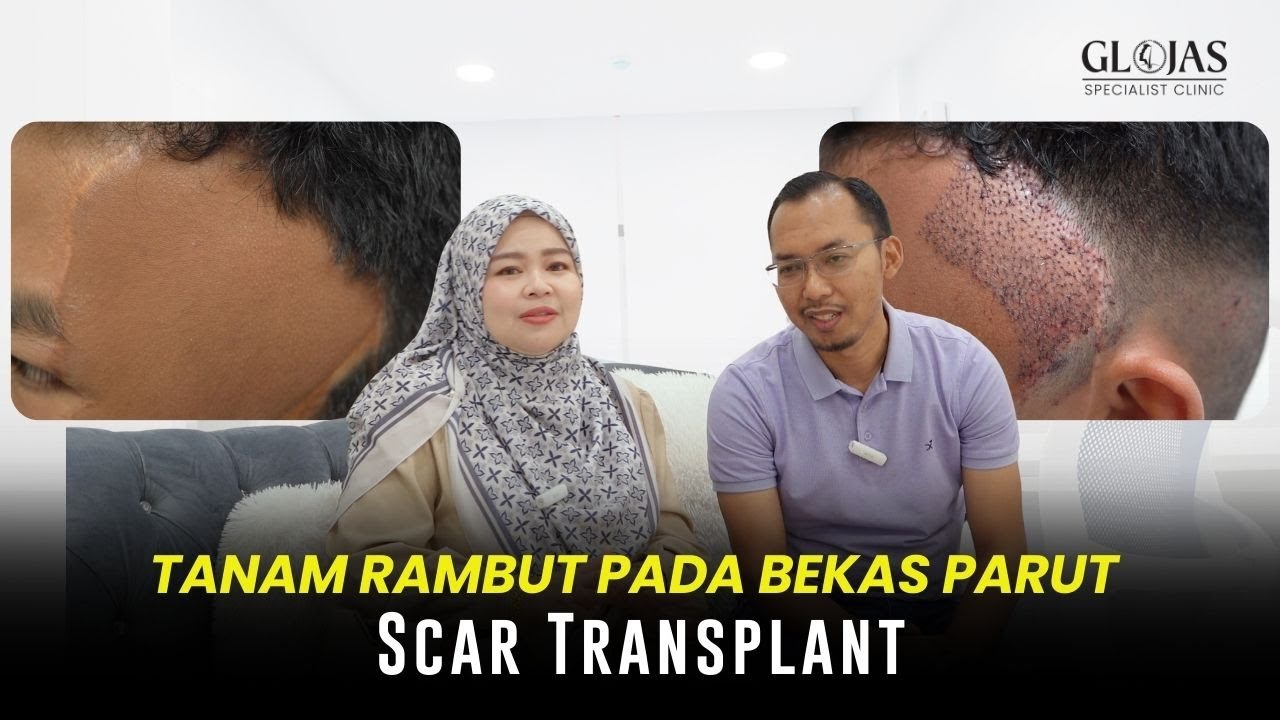 Tanam Rambut | Hasil Tanam Rambut Parut SMART™ FUE Selepas 2 Minggu di ...