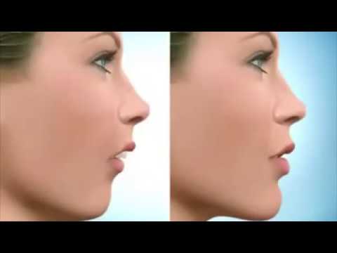 What is Bimaxillary Osteotomy_Orthognathic Surgery - YouTube