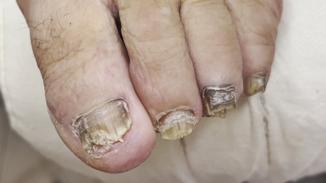 Pedicure Tutorial - Rotten Nail - satisfactory treatment - YouTube