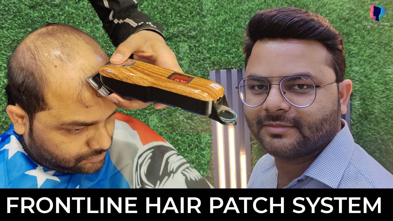 Frontline hair patch system | Australian hair patch | Australian ...