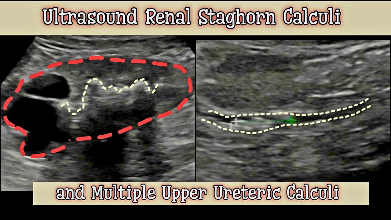 Renal Staghorn Stone - and Multiple Upper Ureteric Stones | Ultrasound ...