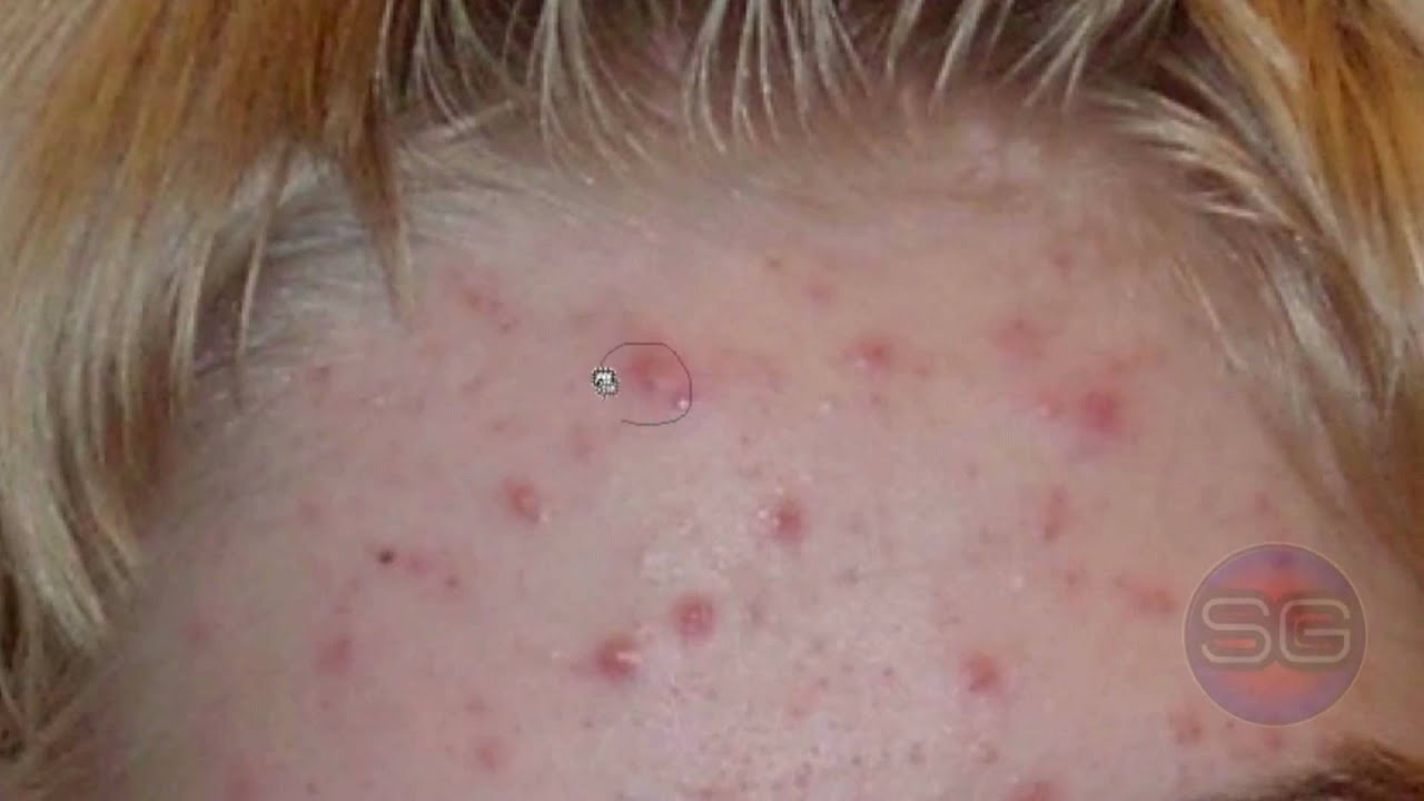 Remove Pimples,Acne,Blemishes within seconds in Photoshop!! - YouTube