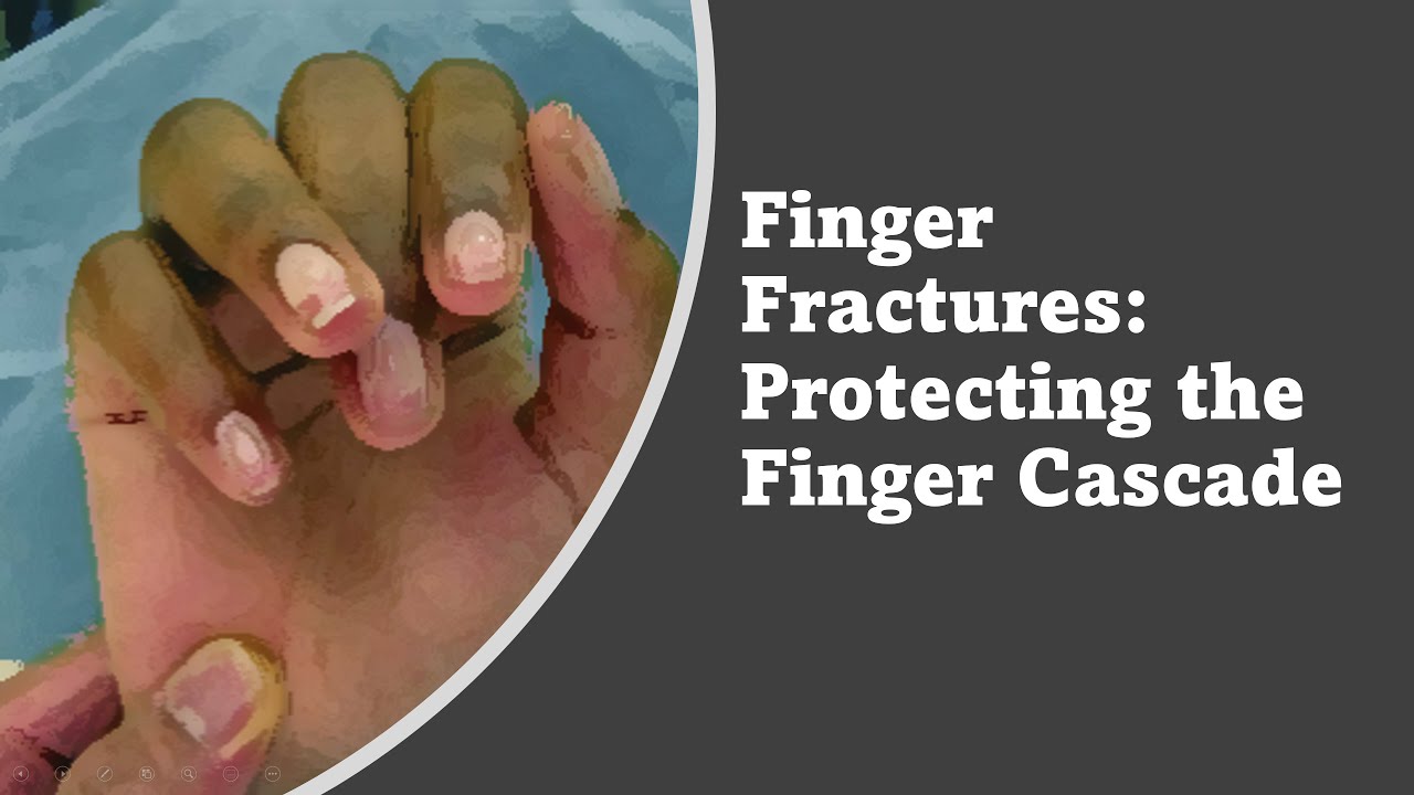 Finger Fracture Emergency Pearls - YouTube