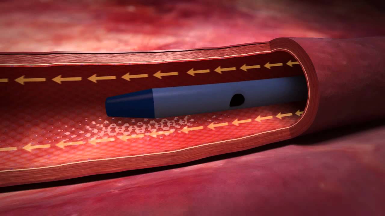 VenousStasis_Reverse Taper Vs Arrow TaperFree PICC.mov - YouTube