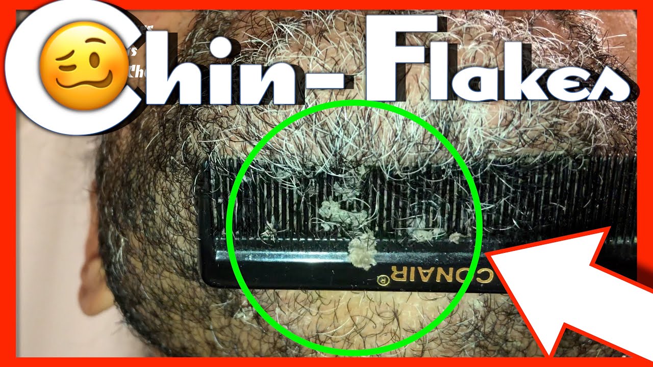 COMBING OUT FLAKES FROM MY BEARD AND MUSTACHE | PitaFlakes - YouTube