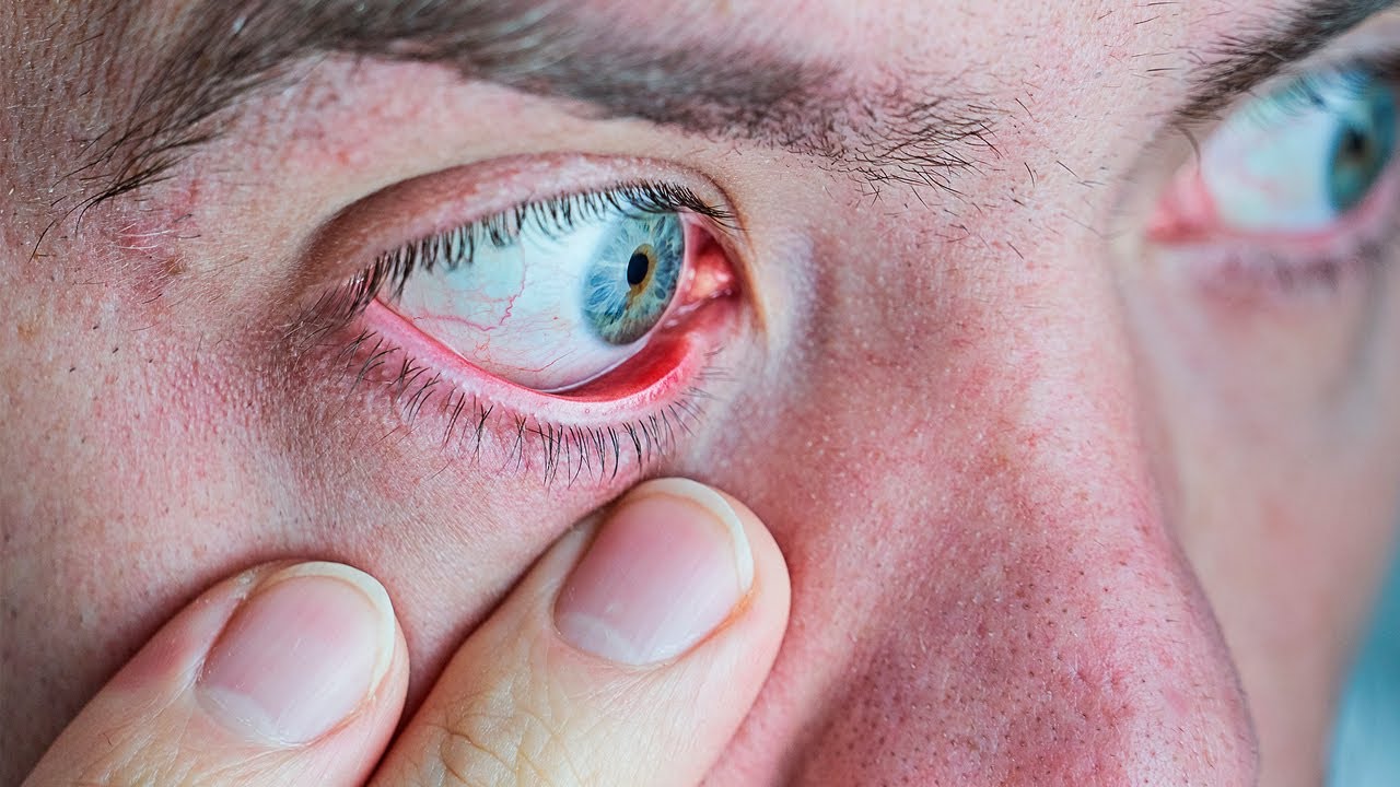 Dry Eyes? Here's What They Reveal About Your Health - YouTube
