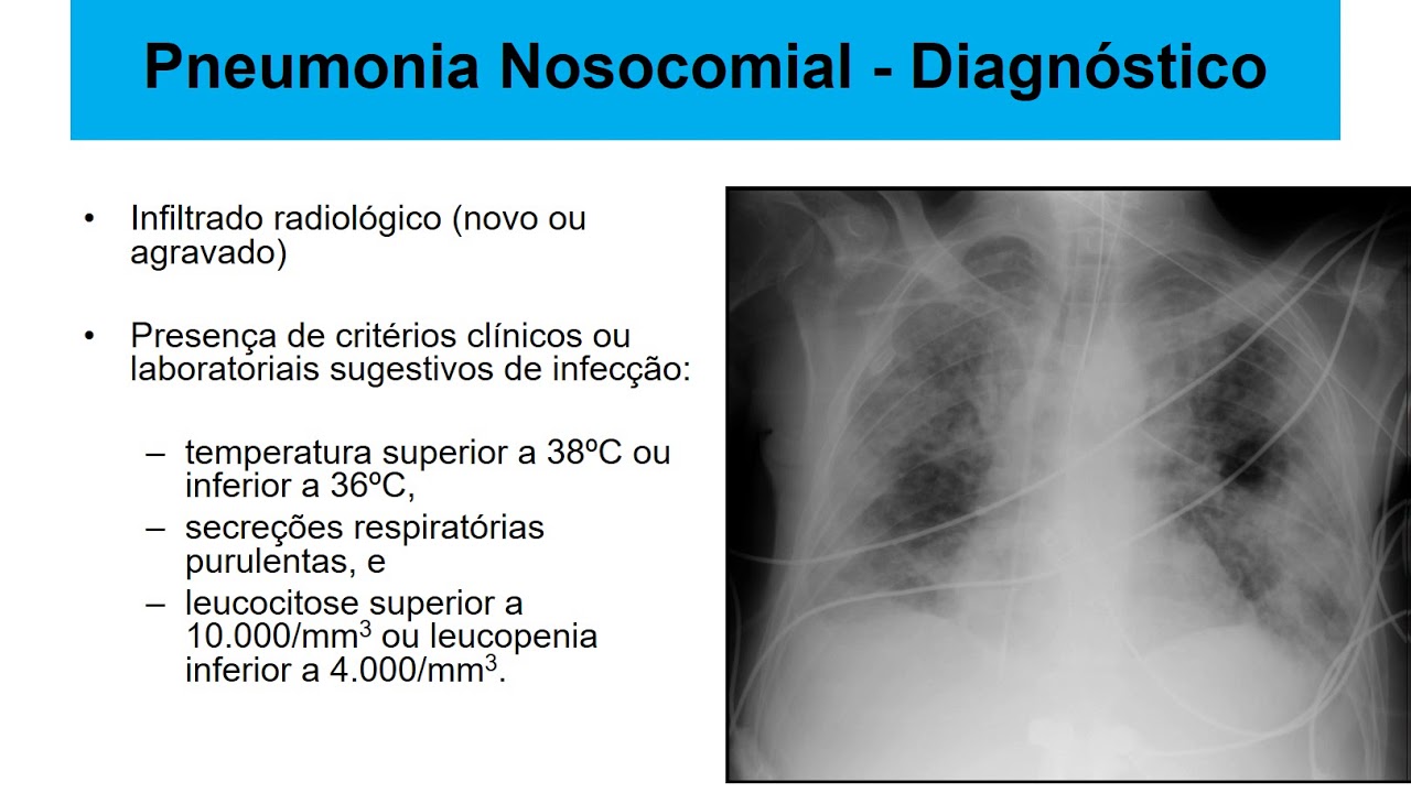 10 Pneumonia Nosocomial - YouTube