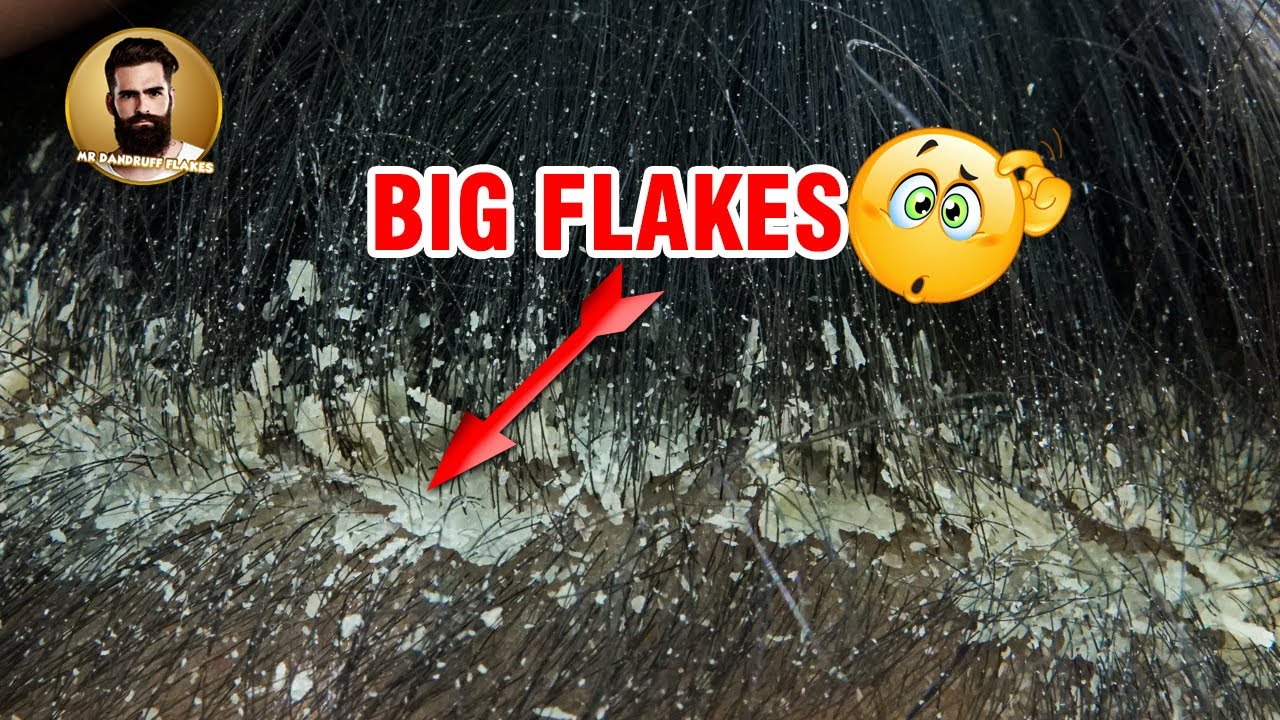 Dandruff Removal With Comb Satisfying #012 - YouTube