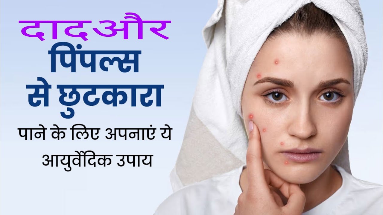 दाद - खाज - खुजली मुंहासे ka ayurvedic treatment || Dad and pimples ...