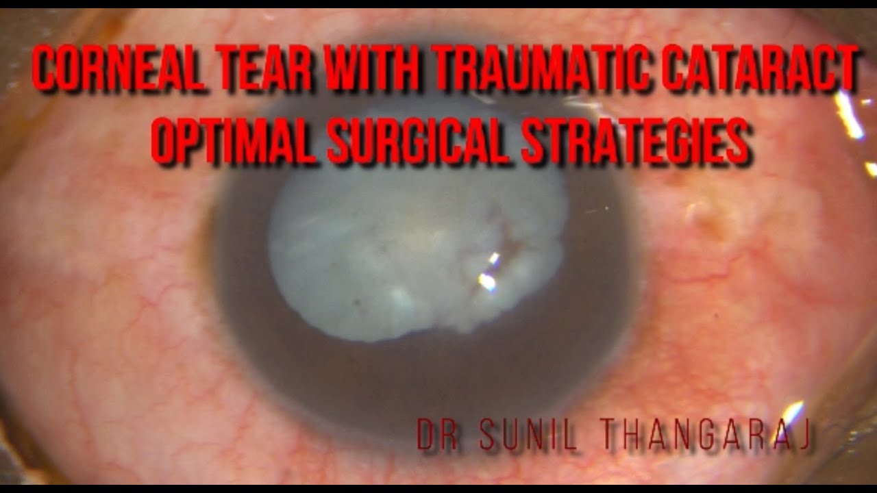 Management of corneal tear with a traumatic cataract - YouTube