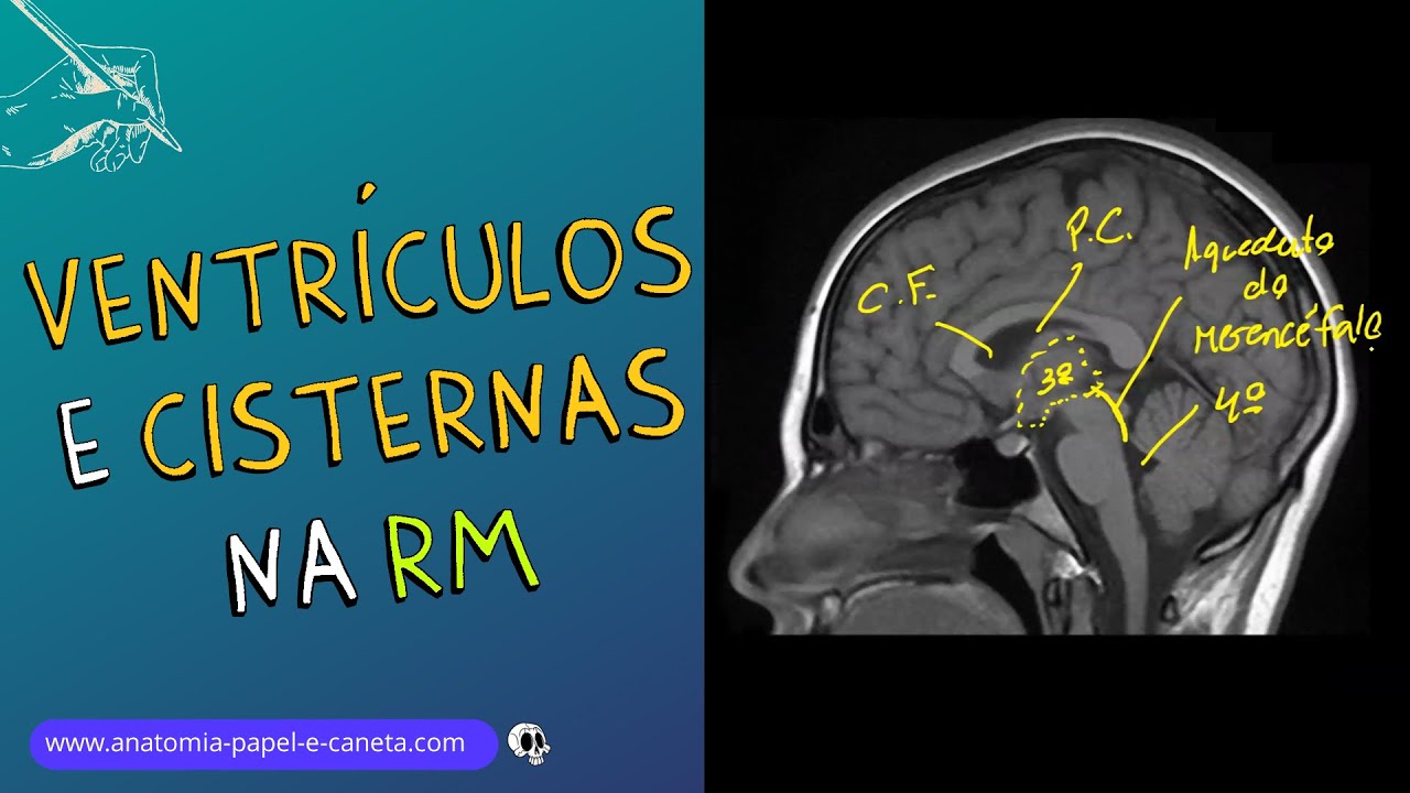 Ventrículos e Cisternas Cerebrais por RM - YouTube
