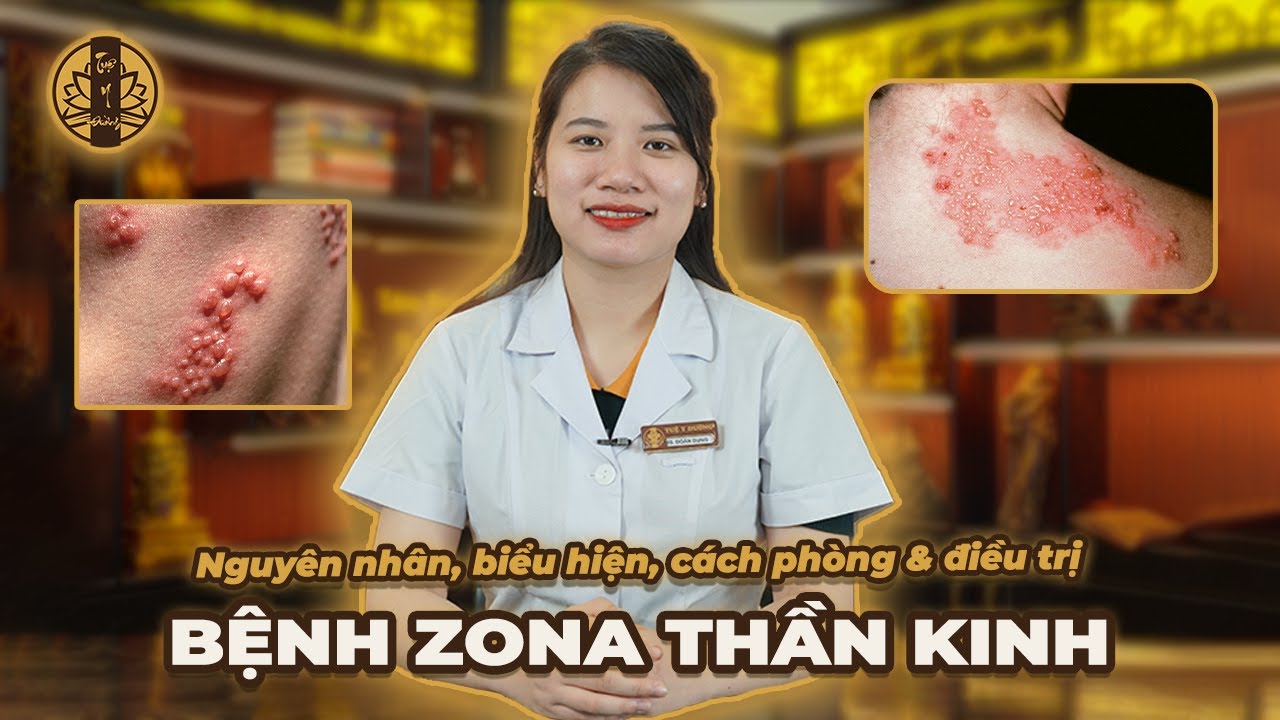 ZONA THẦN KINH và nguyên nhân, biểu hiện, cách phòng & điều trị nó ...