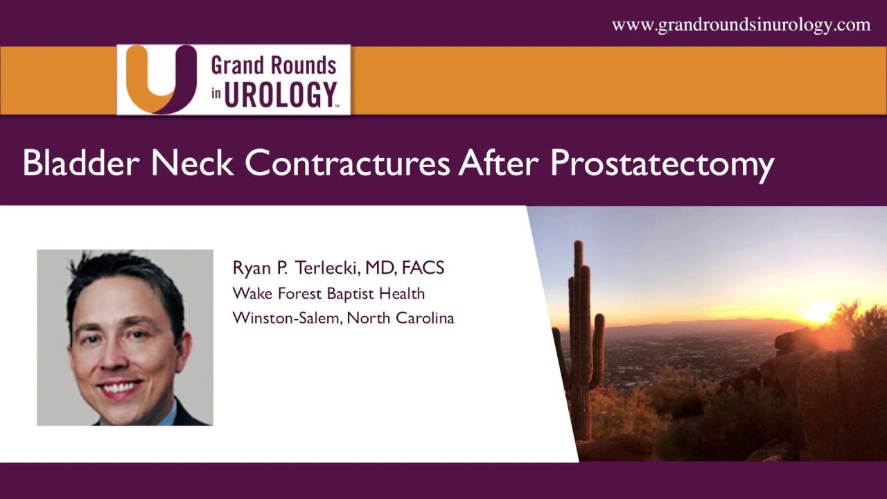 Bladder Neck Contractures After Prostatectomy - YouTube