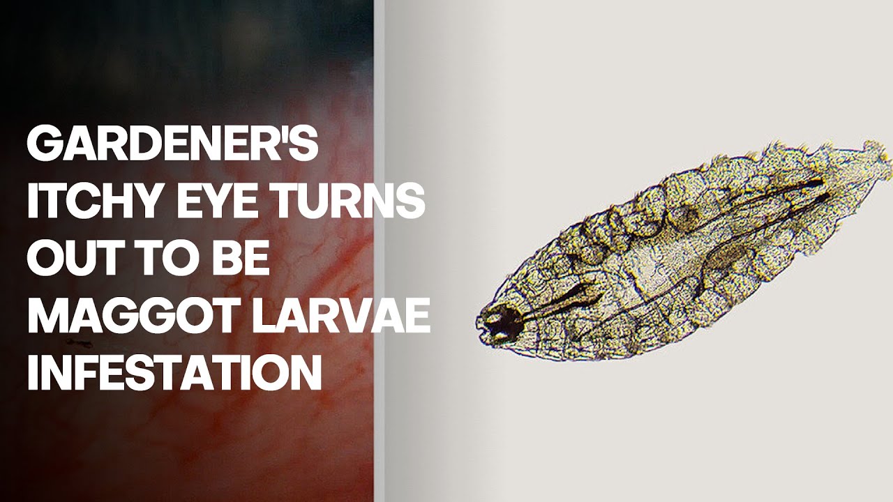 Gardener's itchy eye turns out to be maggot larvae infestation - YouTube
