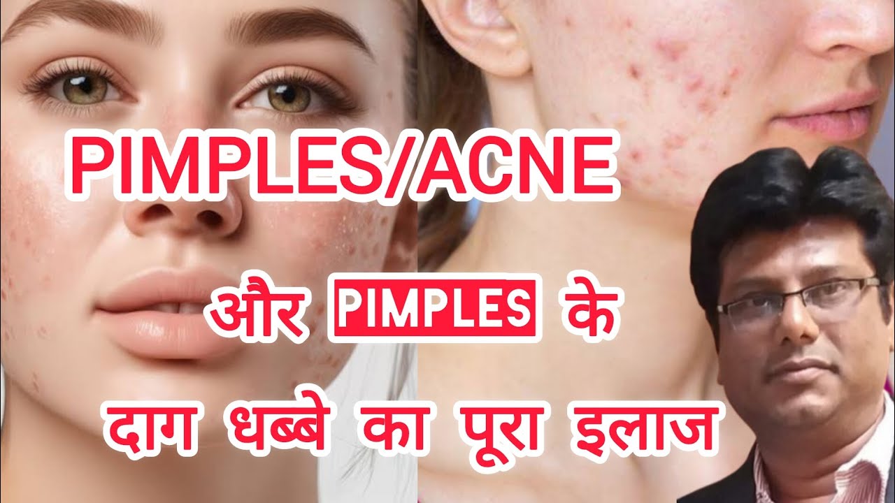 Pimples aur pimples ke daag ka pura ilaj - YouTube