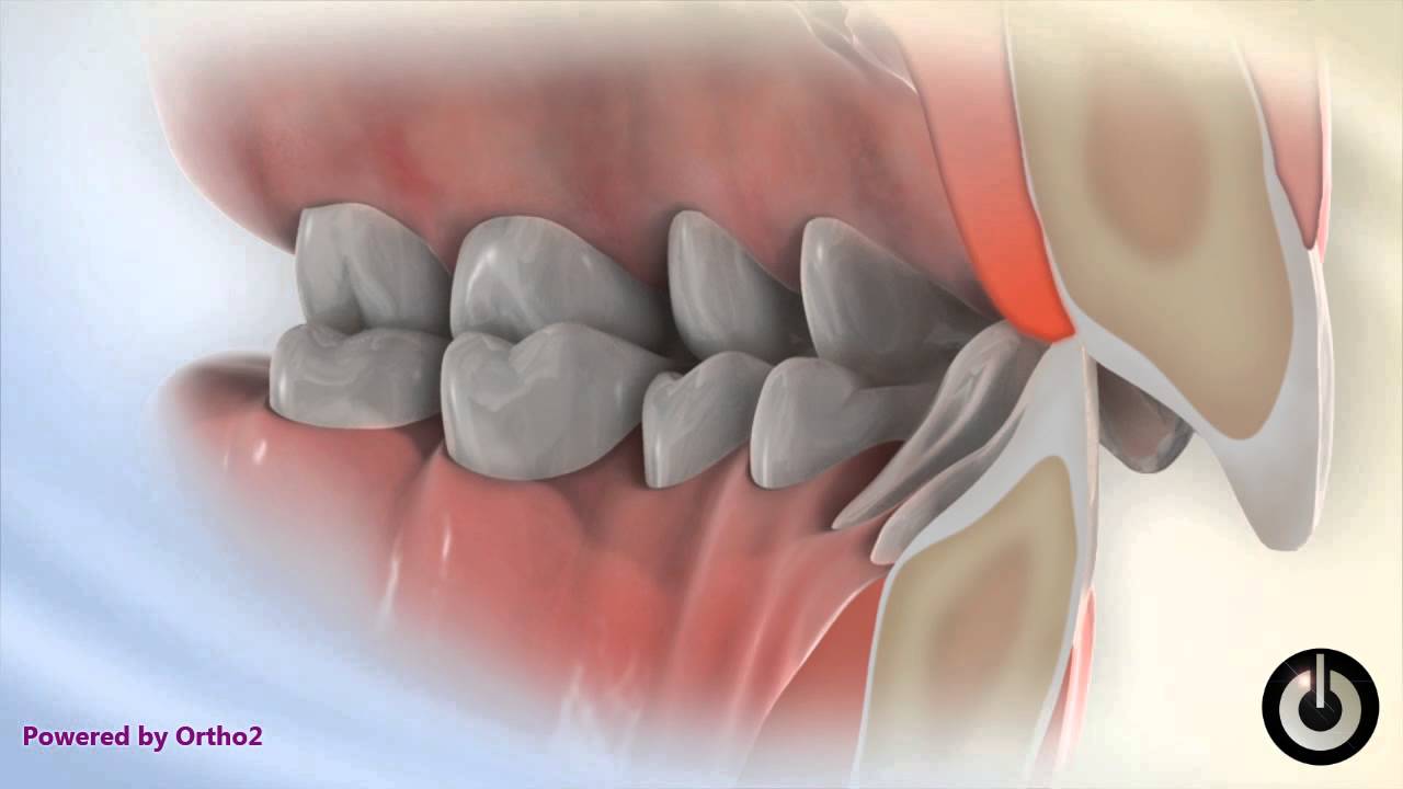 Deep Impinging Bite - YouTube