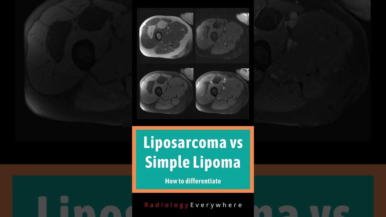 How To Differentiate Liposarcoma From Lipoma Msk Radiology 1000 Cases In 100 Days Video 41