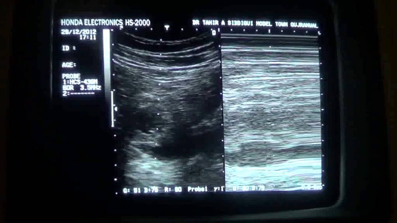 ectopic gestational sac fetal pole with cardiac flicker and bleed - YouTube