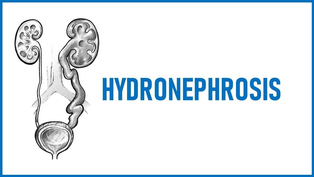 Hydronephrosis Lecture - YouTube