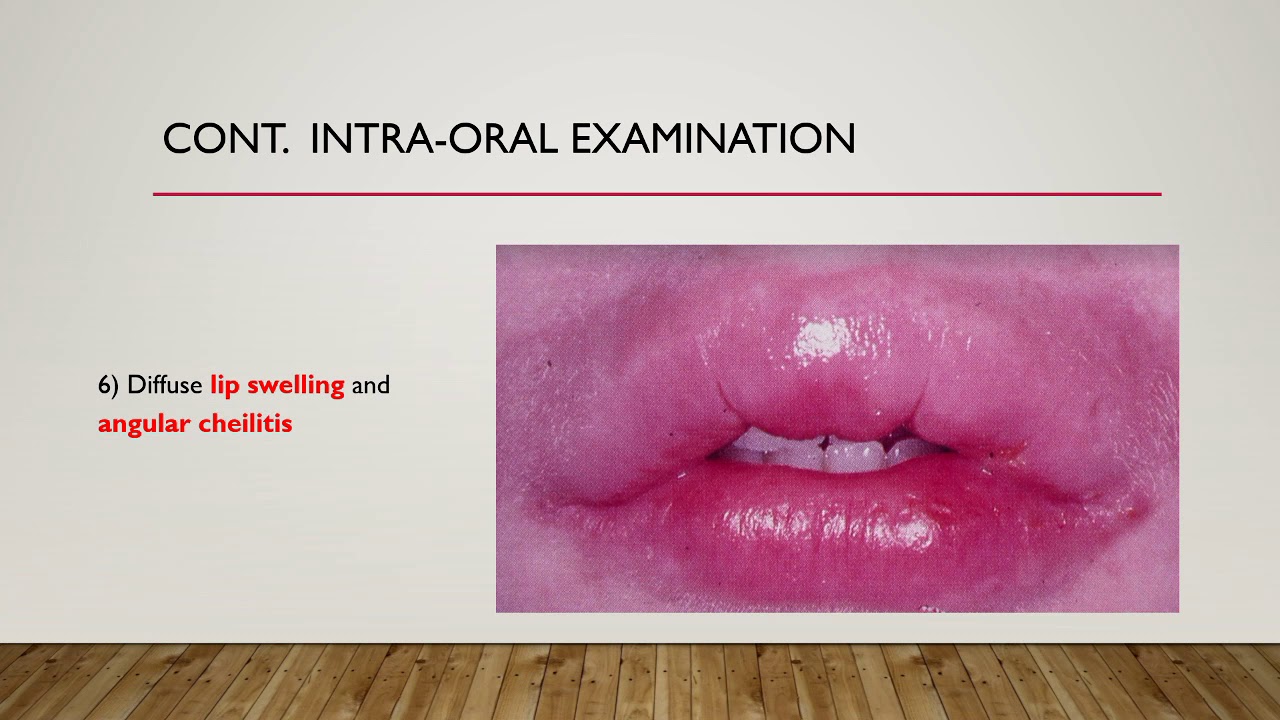 Crohn's Disease with Oral Manifestations - YouTube