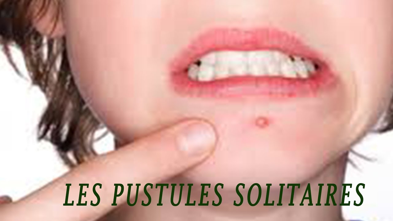 LES PUSTULES SOLITAIRES - YouTube