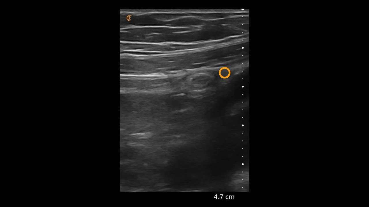 Appendicitis – Ultrasound Image Interpretation - YouTube