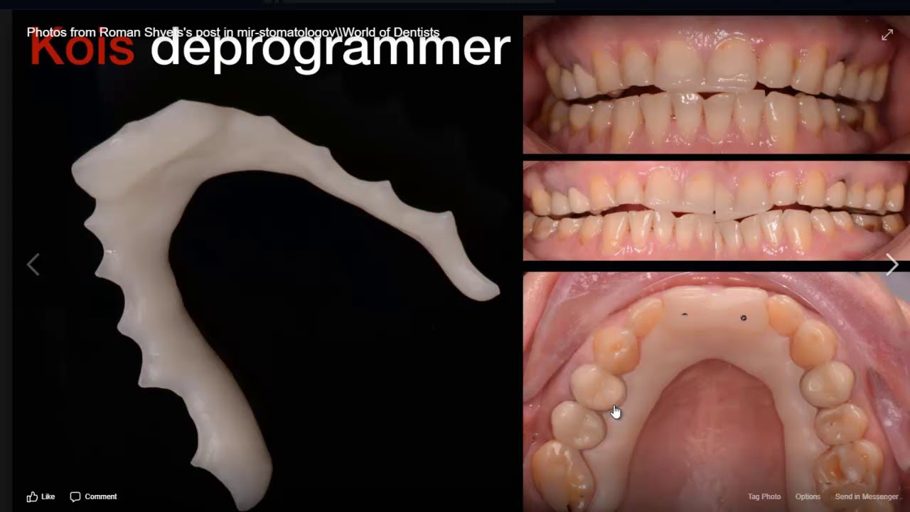 Kois Deprogrammer Mistakes - YouTube