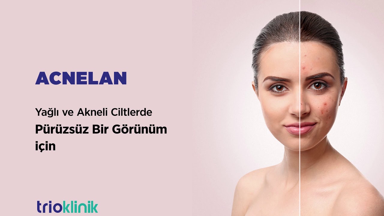 Acnelan Nedir? Akne Tedavisi - YouTube