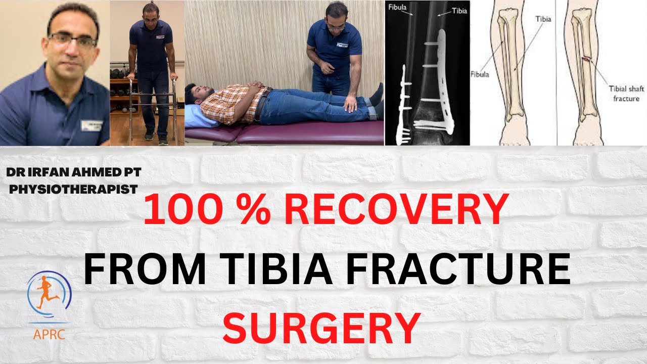Learn Everything About Lower leg fractures Recovery & Exercises at Home ...