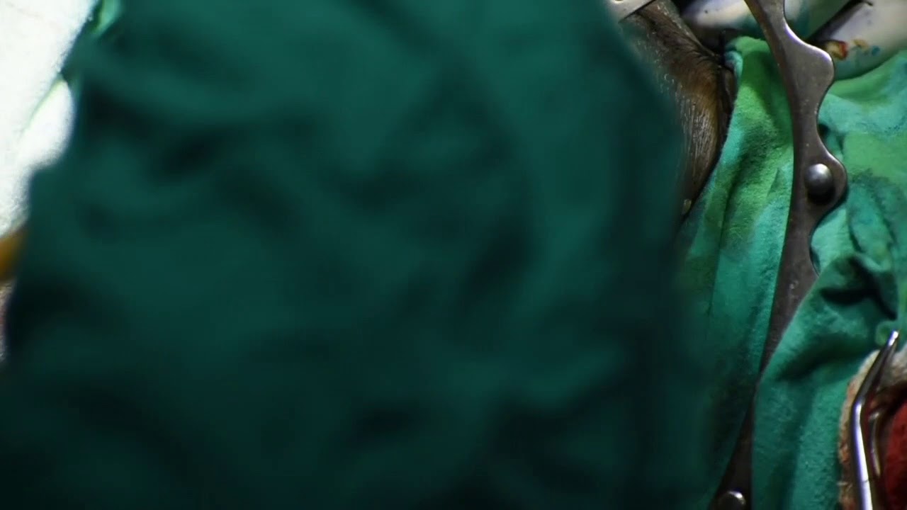 Bulbar Anastomotic Urethroplasty - YouTube