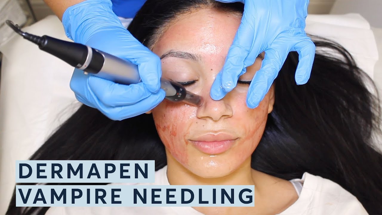 Dermapen - Vampire Needling Treatment - YouTube