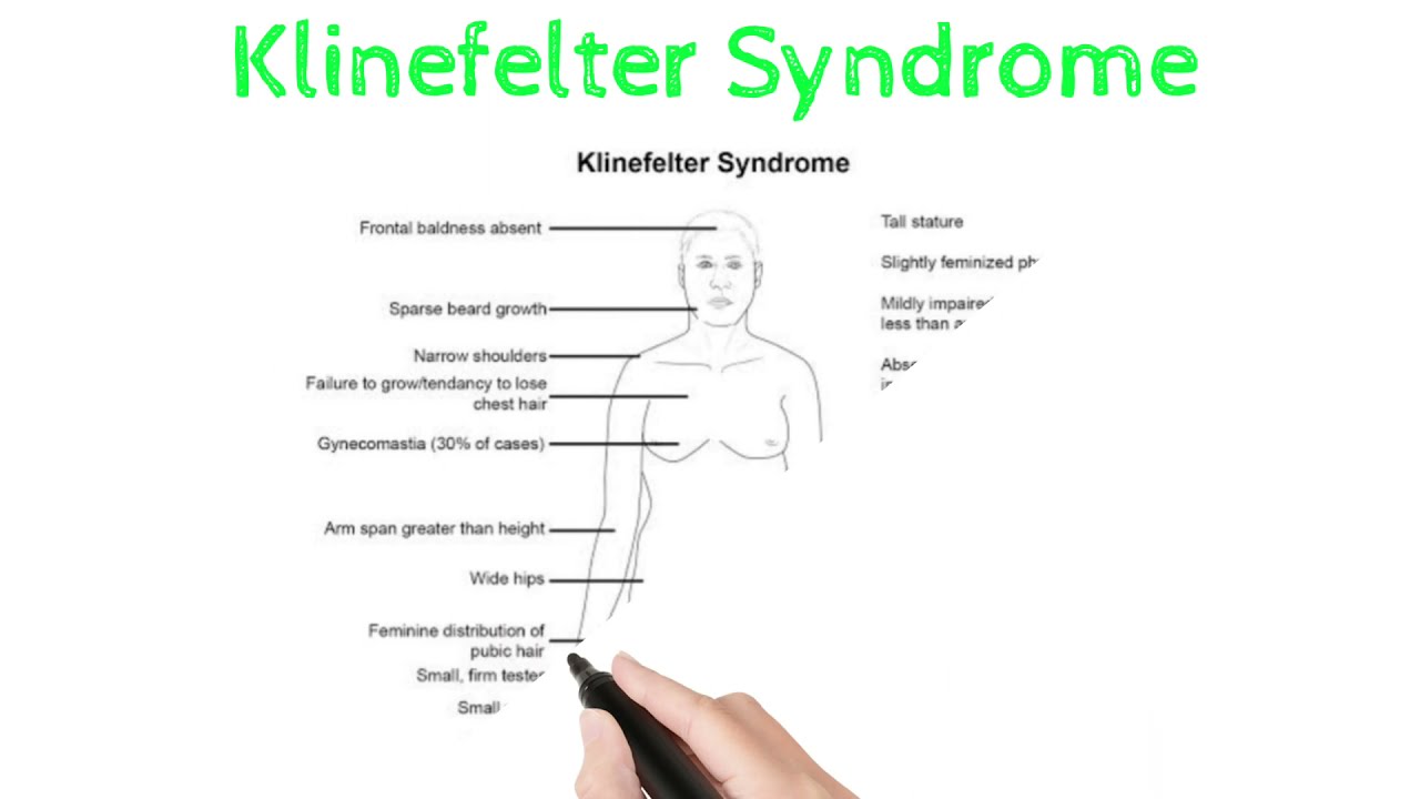 Klinefelter Syndrome#Anatomy#Genetics#Sexchromosomalabnormality - YouTube
