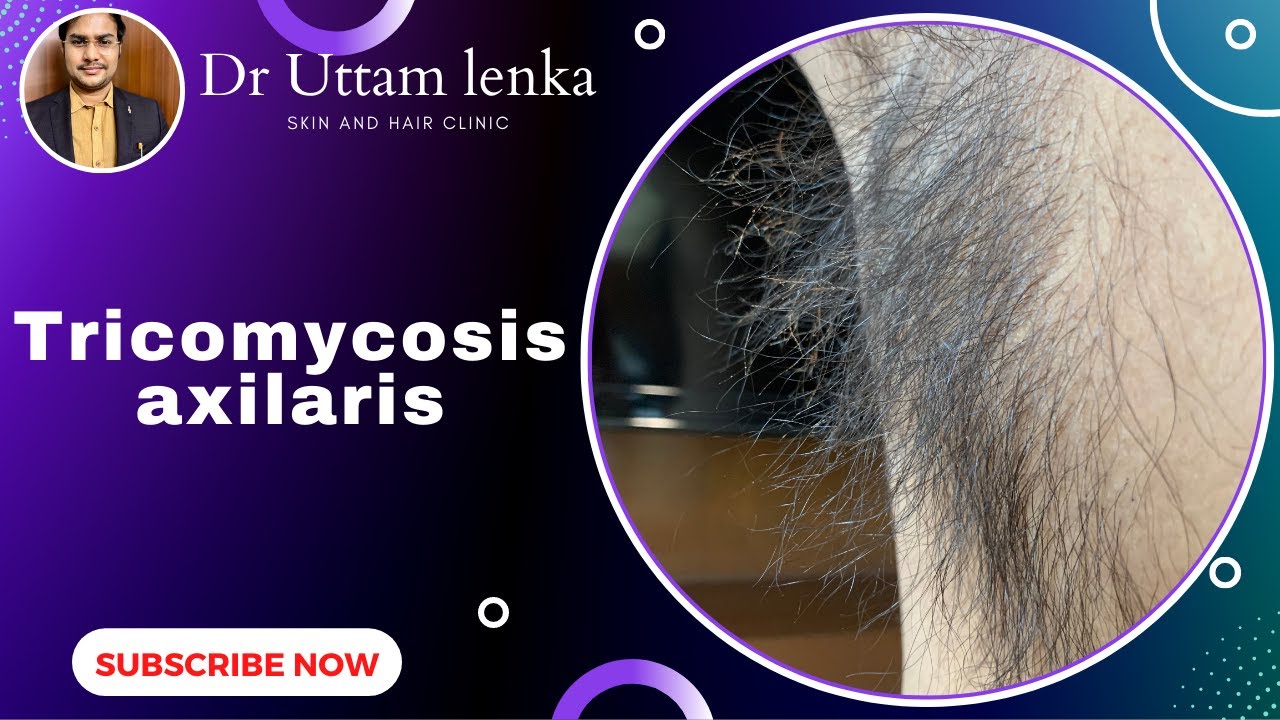 Tricomycosis Axilaris /yellow colour hair in armpit/ बगल में पीला बाल ...