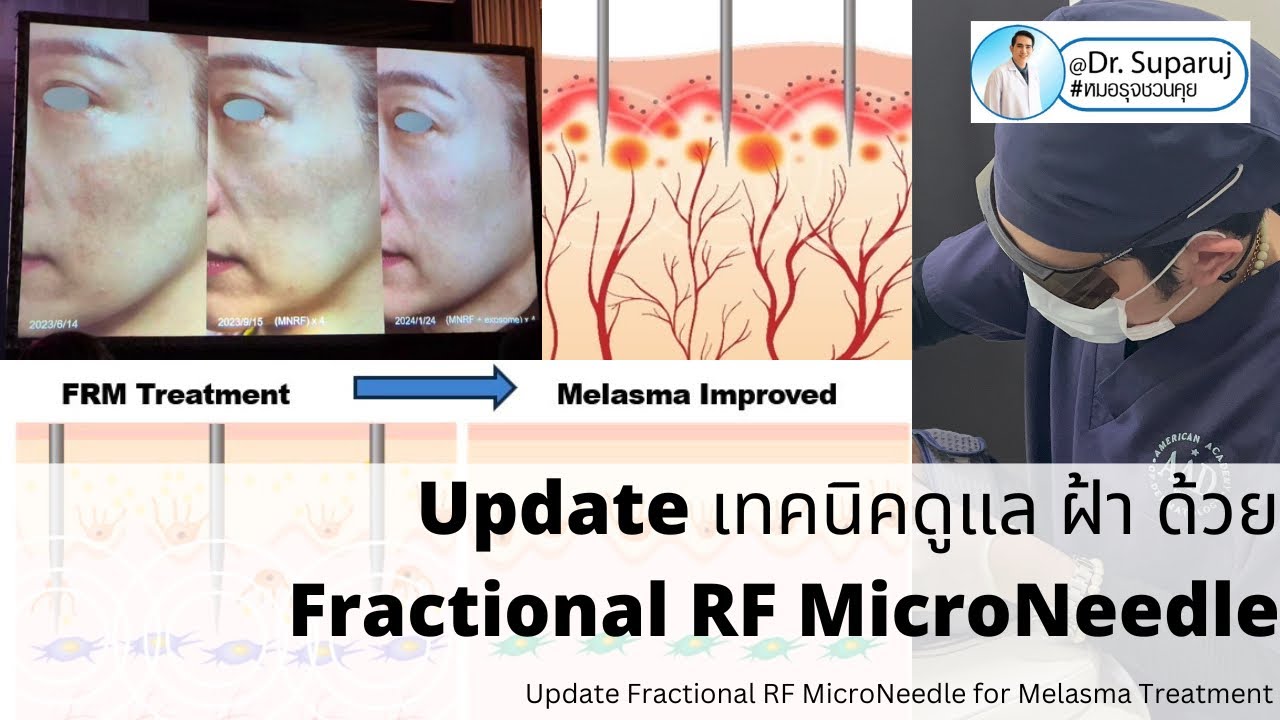 เทคนิคดูแล รักษาฝ้า ด้วย Fractional RF MicroNeedle for Melasma ...